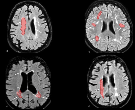 White Matter Hyperintensity and Vascular Disease from Biological Basis to Clinical Significance